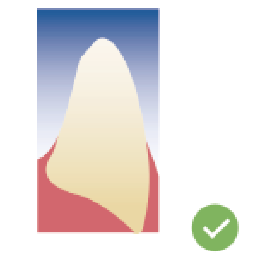 Resin-base Injector – YPDENTAL